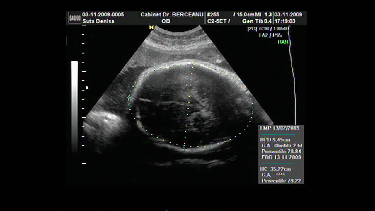 Câte ecografii poți face în timpul sarcinii? Recomandări oficiale